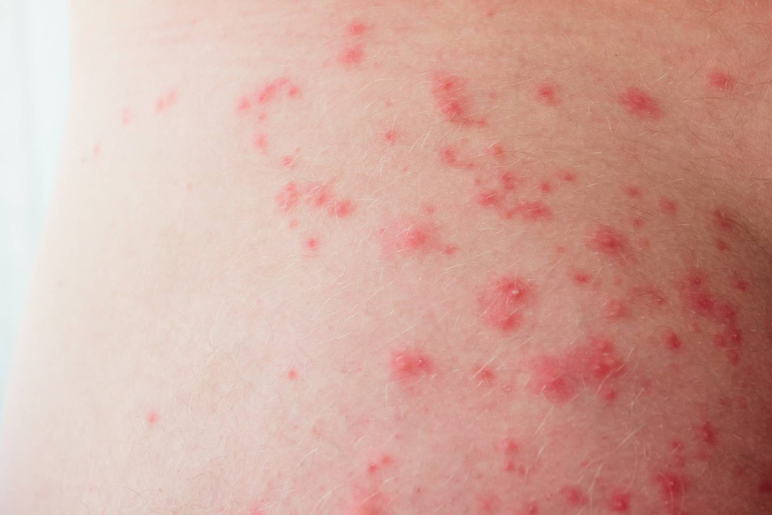 Skydliaukė: priežastys, simptomai ir gydymas