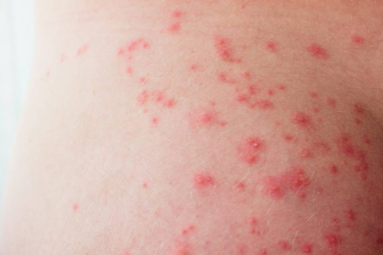 Cholesterolio norma pagal amžių - SveikatosRumai.lt